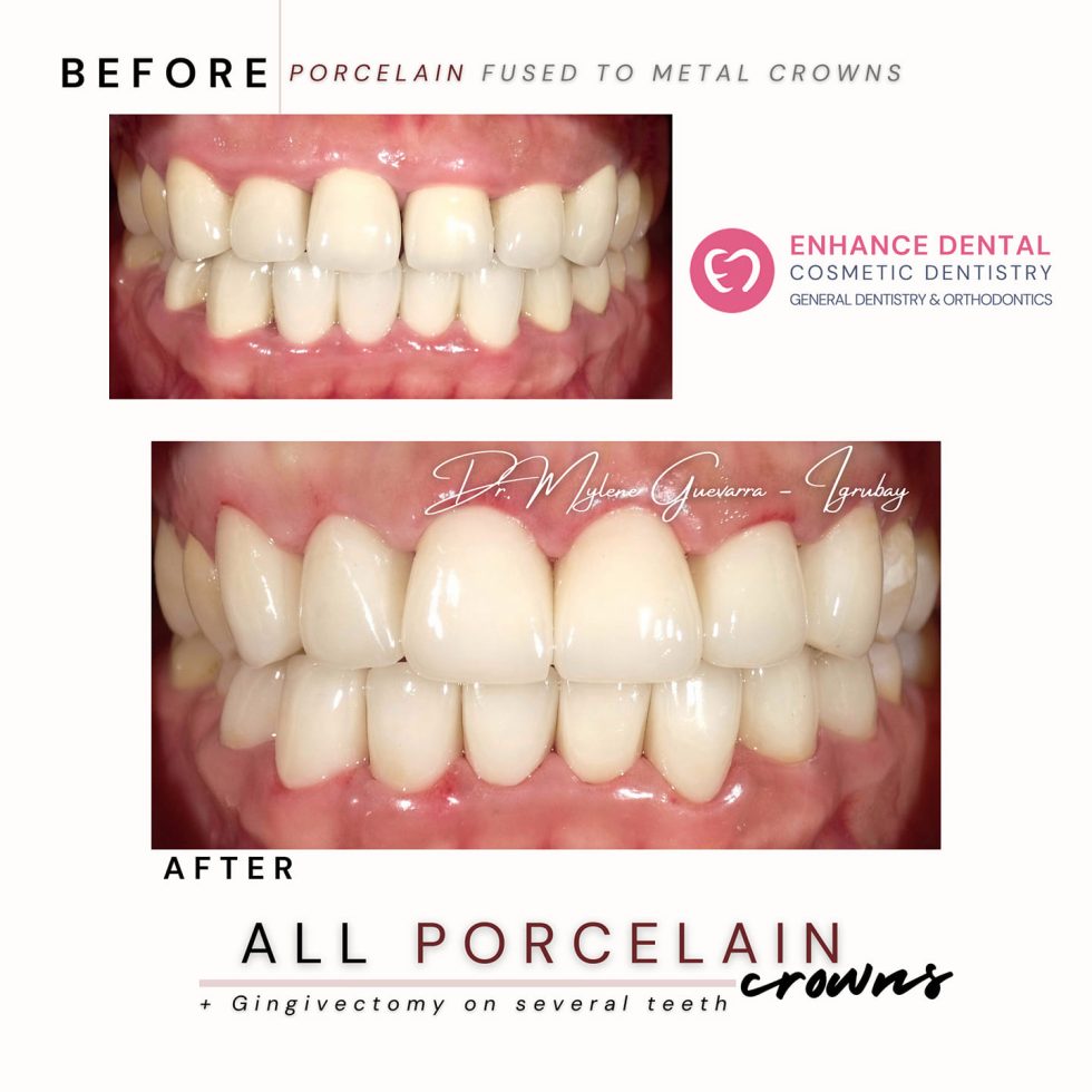 ALL PORCELAIN CROWNS | Enhance Dental