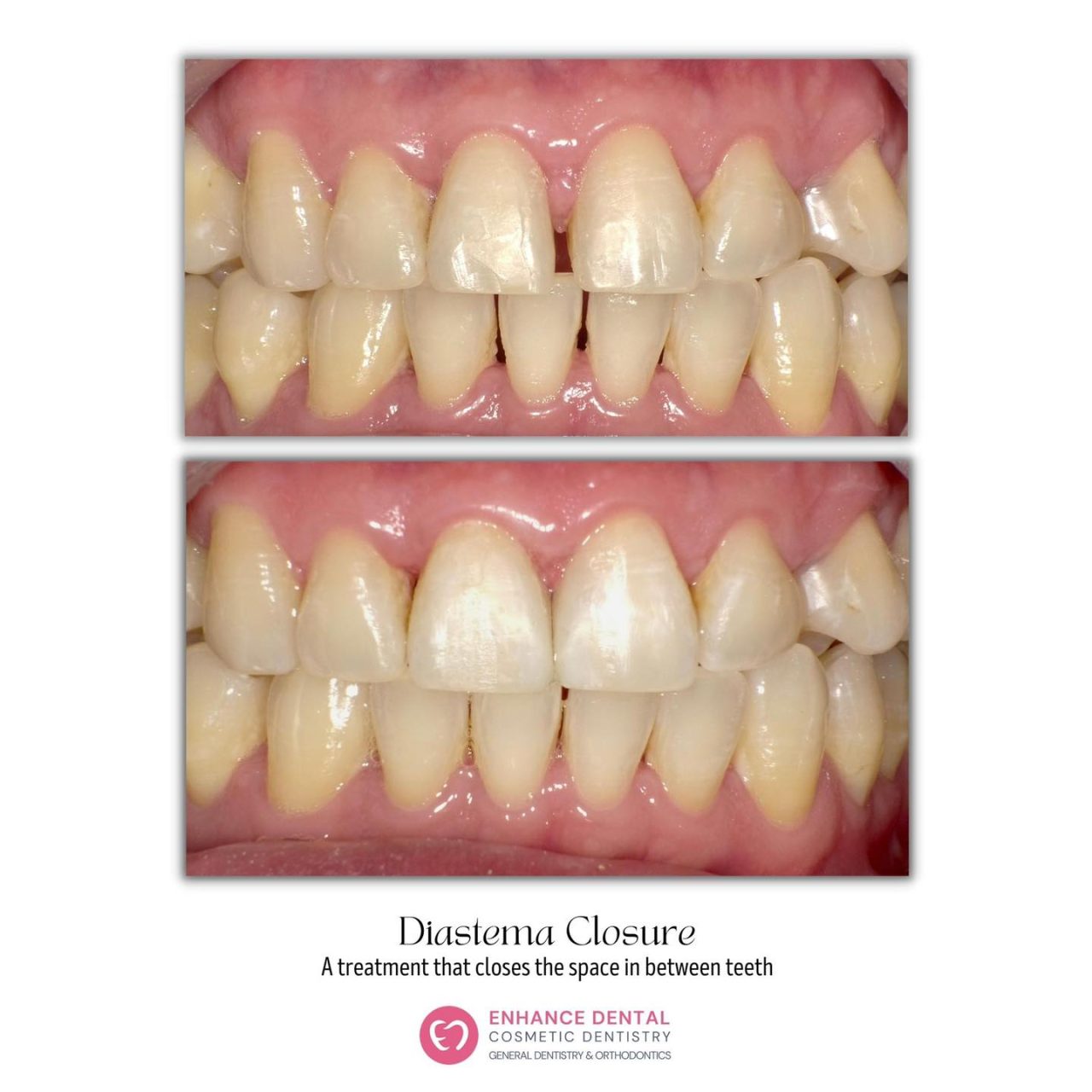 Diastema Closure | Enhance Dental