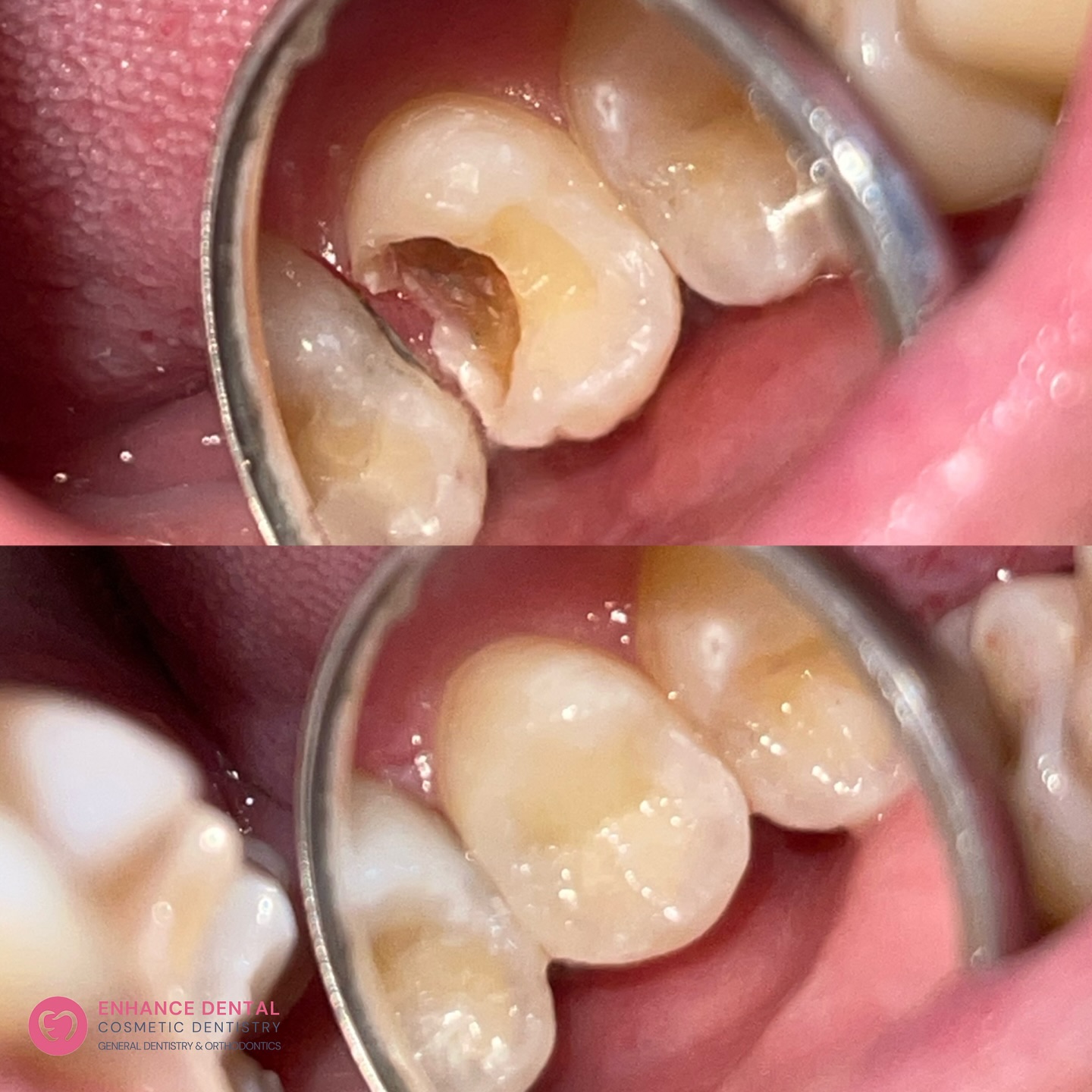 Class II Restoration | Enhance Dental